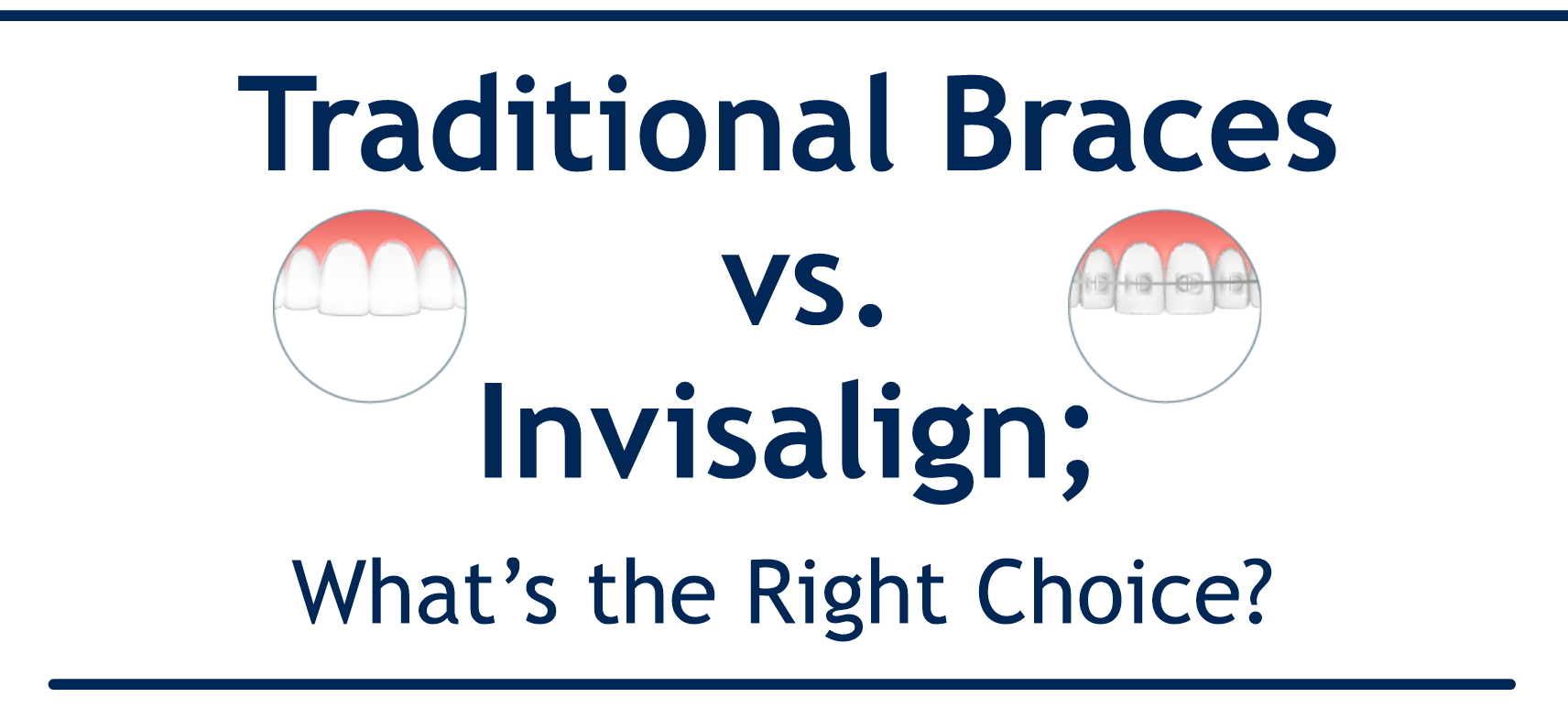 Traditional Braces vs Invisalign Clear Aligner: Which is Better?