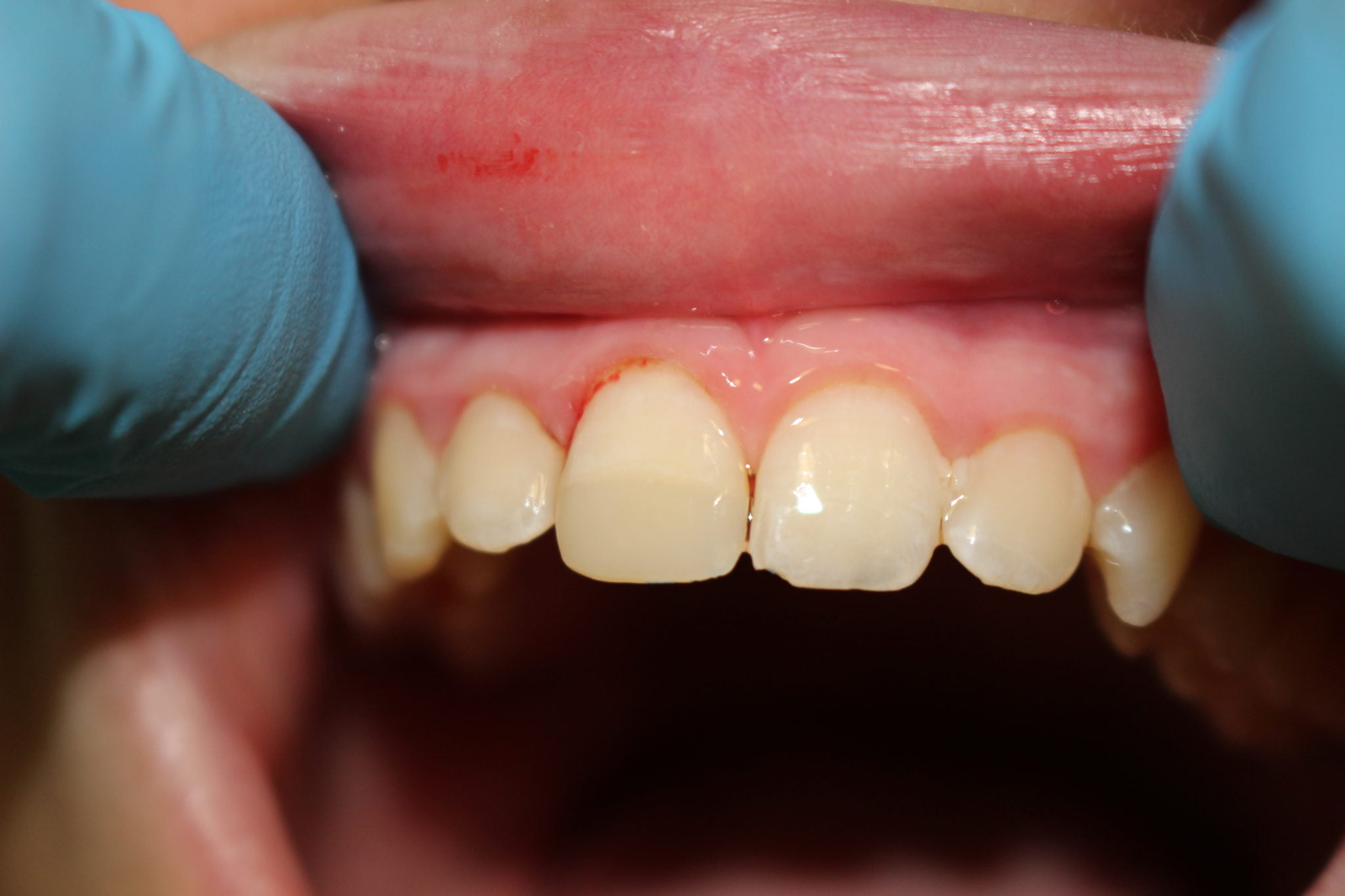 Same Day Broken Teeth Smile Fixing Treatment - Airdrie Dentist