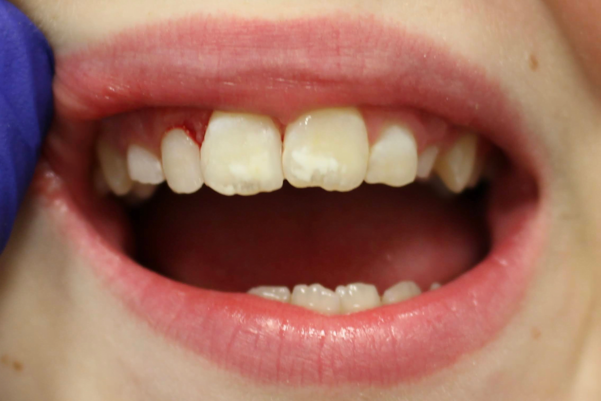 Dental Fillings Smile Reveal - Airdrie Springs Dental