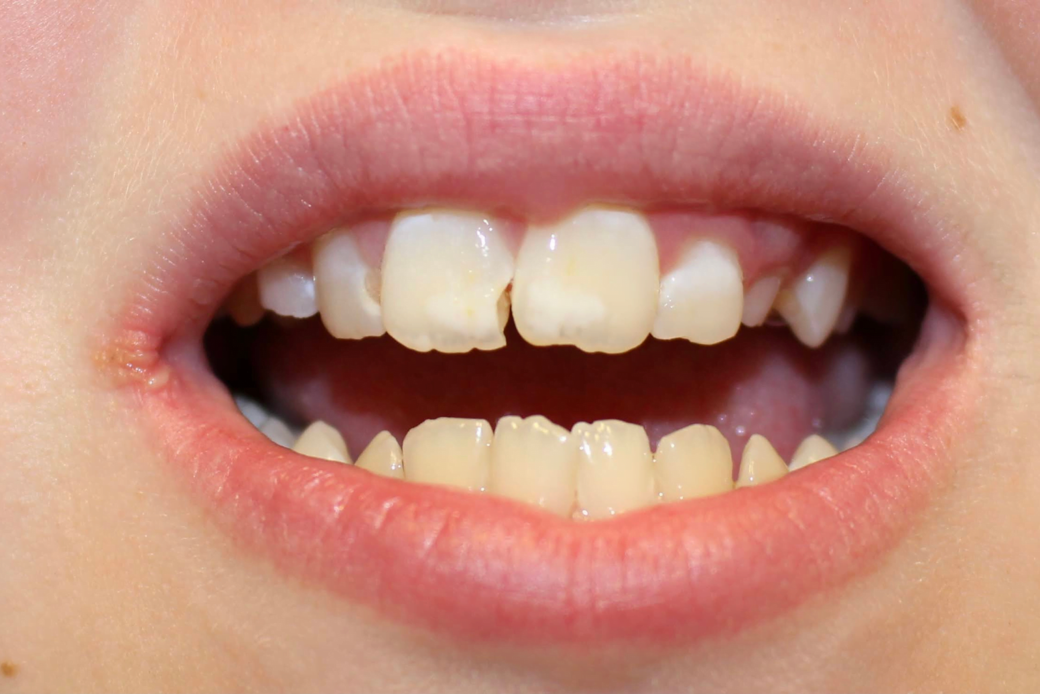 Dental Fillings Smile Reveal - Airdrie Springs Dental