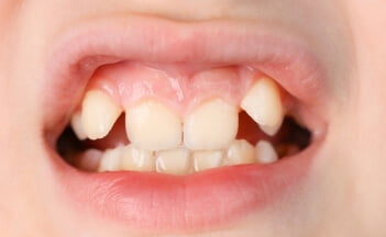 Invisalign Airdrie Braces: Teeth Straightener Clear Aligners