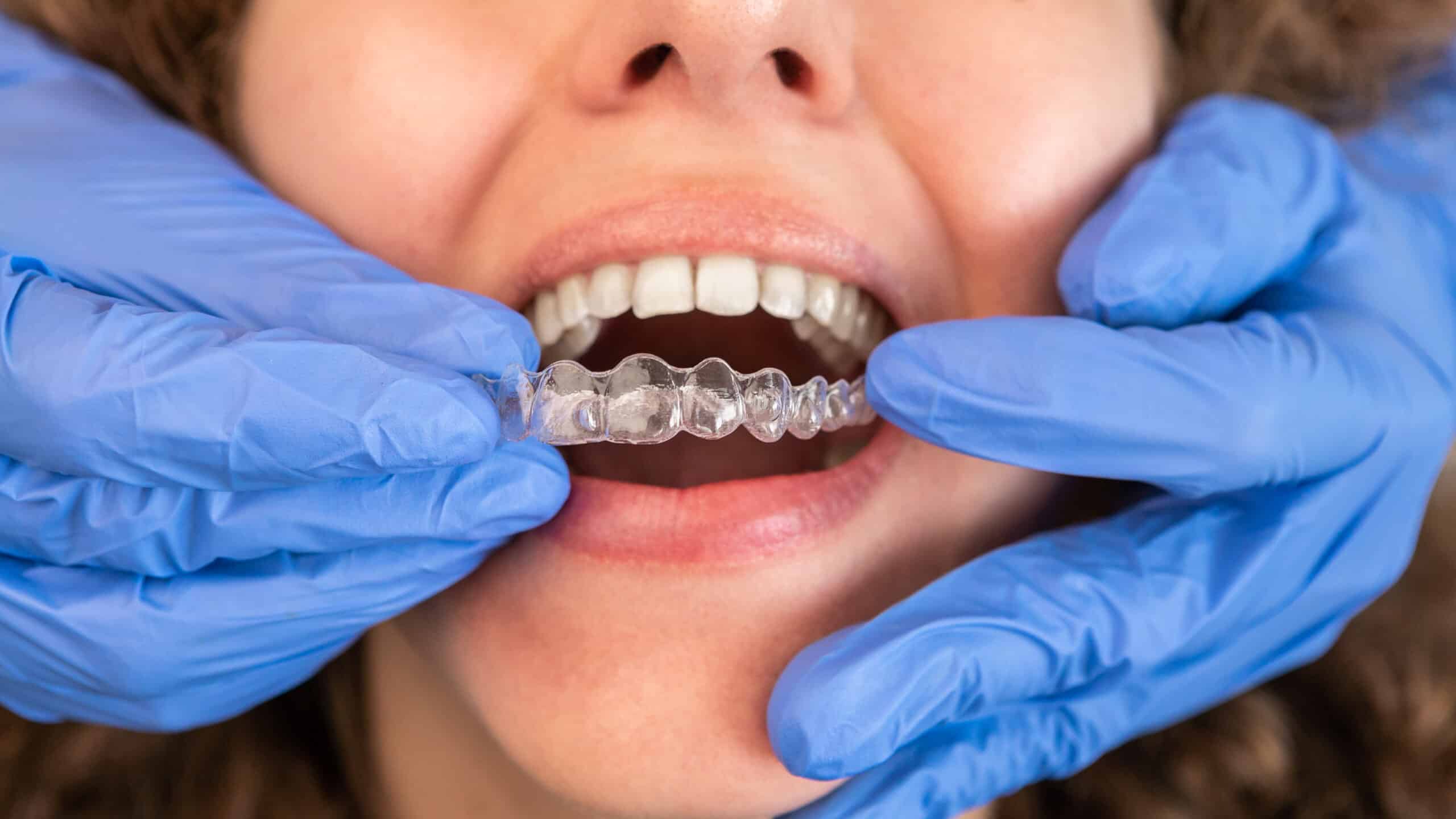 Factors That Affect Invisalign Treatment Duration